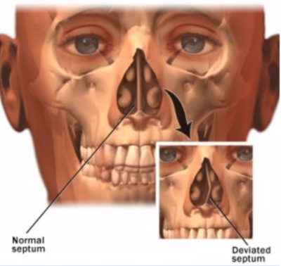 Septal Reconstruction in Los Angeles - Septum Reconstruction