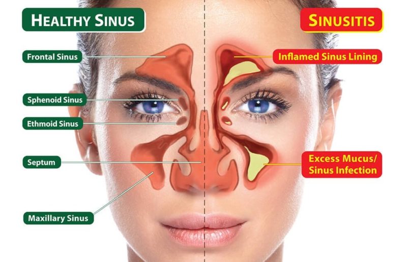 Sinusitis FAQs - Westside Sinus